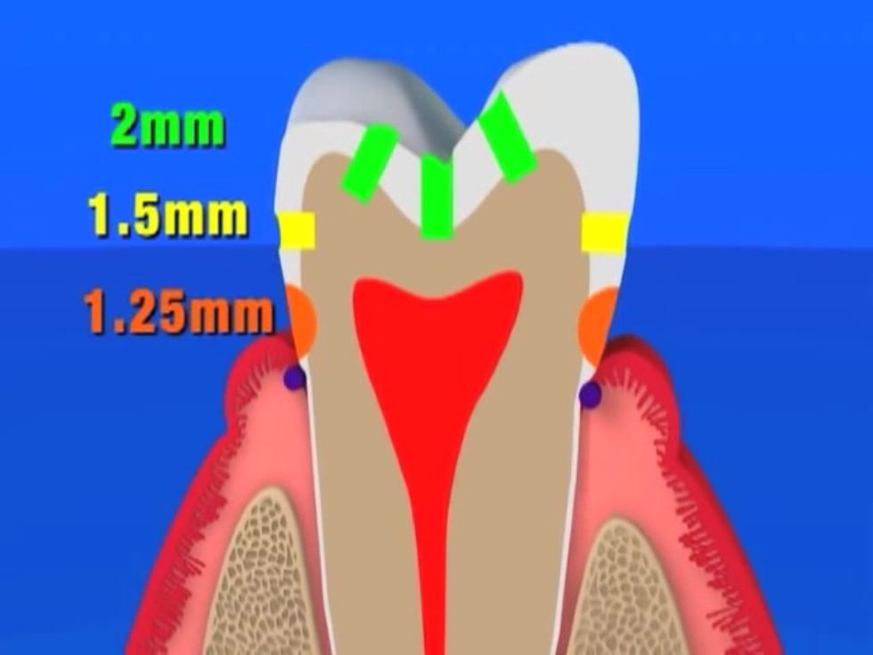 How to prepare a pfm crown - B+C Guides