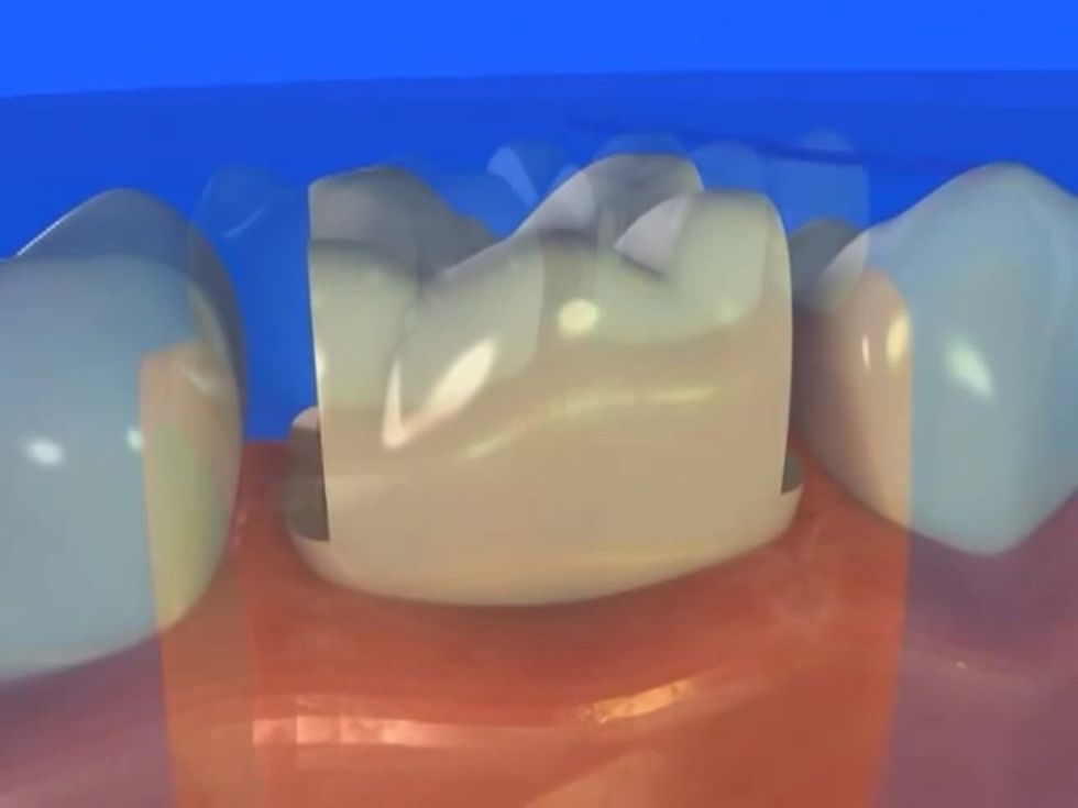 How to prepare a pfm crown - B+C Guides